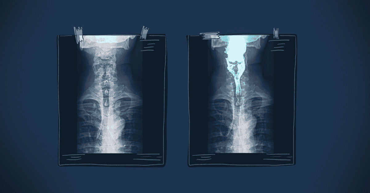 Barium Swallow Study and Myasthenia Gravis